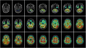 Qubiotech | Neurocloud PET
