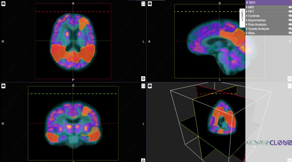 Qubiotech | Neurocloud PET